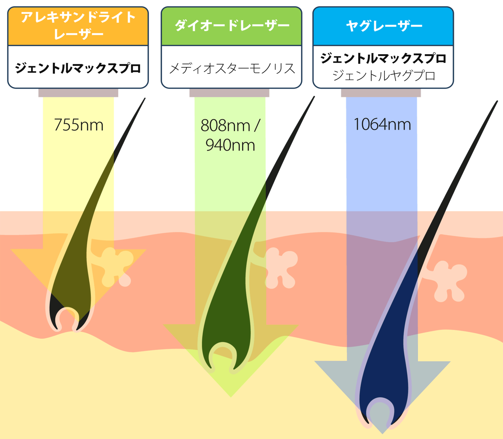 ジェントルマックスプロ（医療レーザー脱毛・熱破壊式） | 沖縄那覇の美容皮膚科エルプラスクリニック【公式】